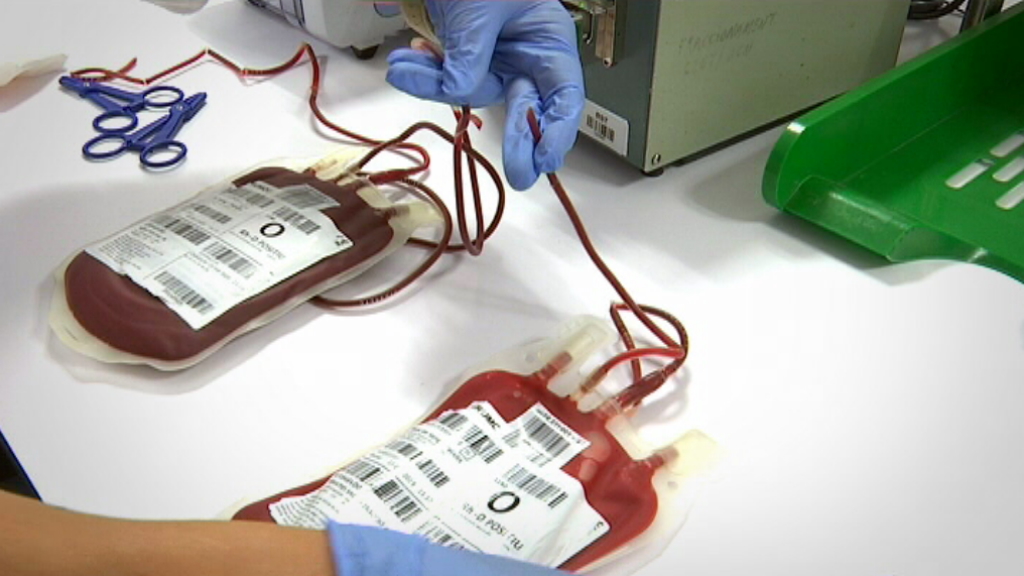 Transfusions intrauterines i "ex sanguino" quan els receptors són fetus ...